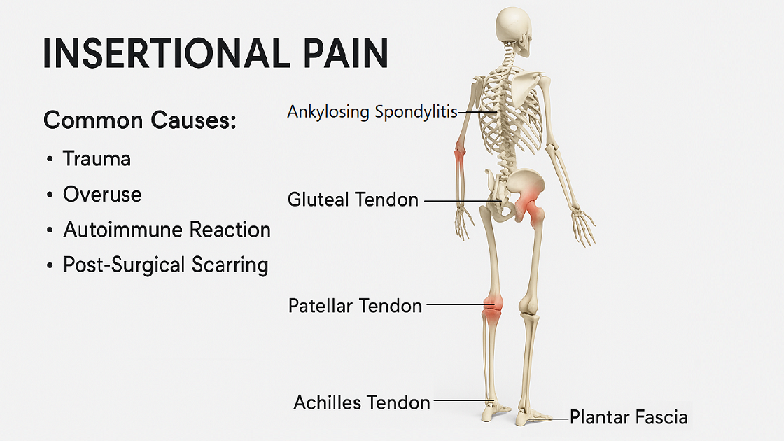 Shockwave Therapy and Insertional Pain Recovery — shockwavemachines ️
